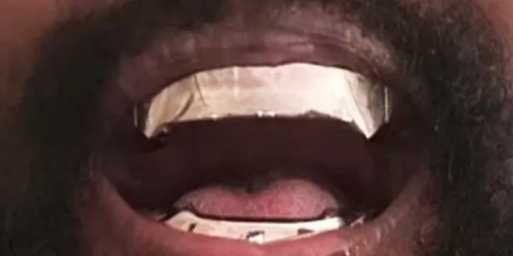 Doctor Warns Kanye West About His Titanium Teeth, Makes a Concerning ...
